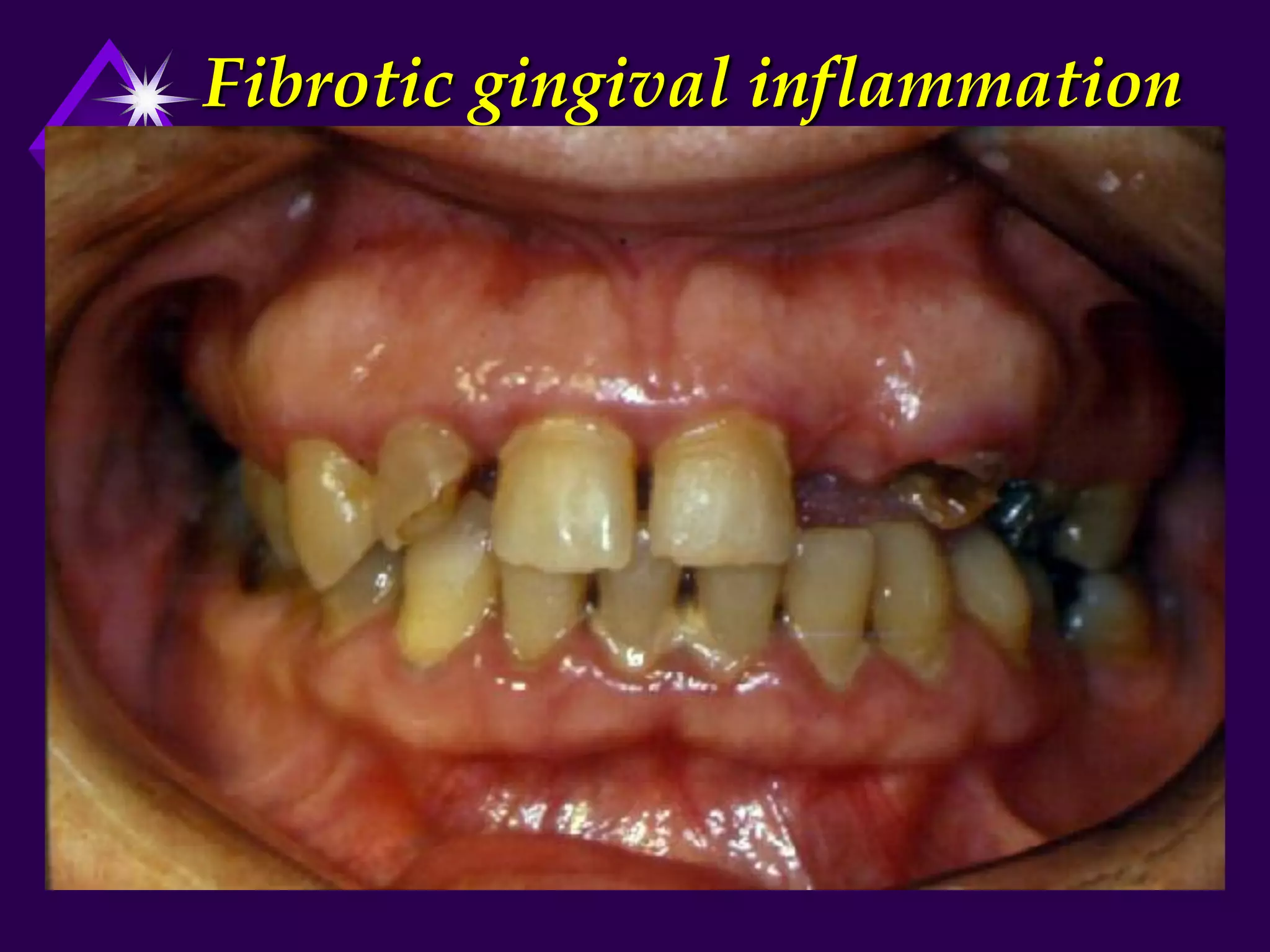 Chronic gingivitis | PDF
