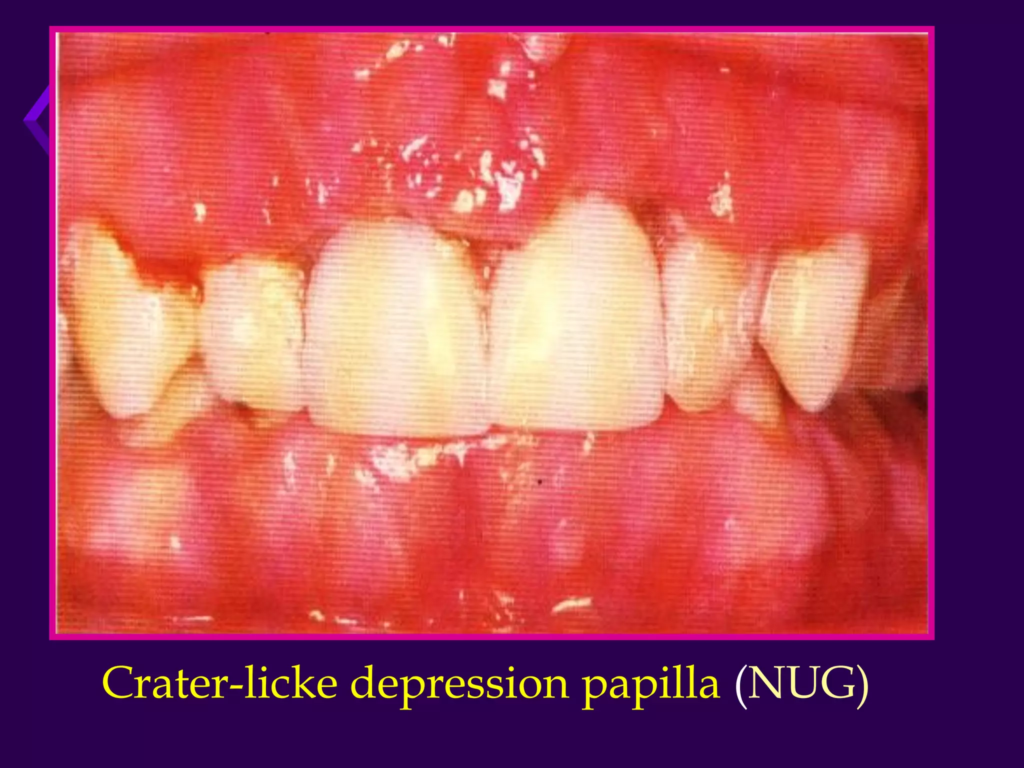 Chronic gingivitis | PDF | Dental Health | Diseases and Conditions