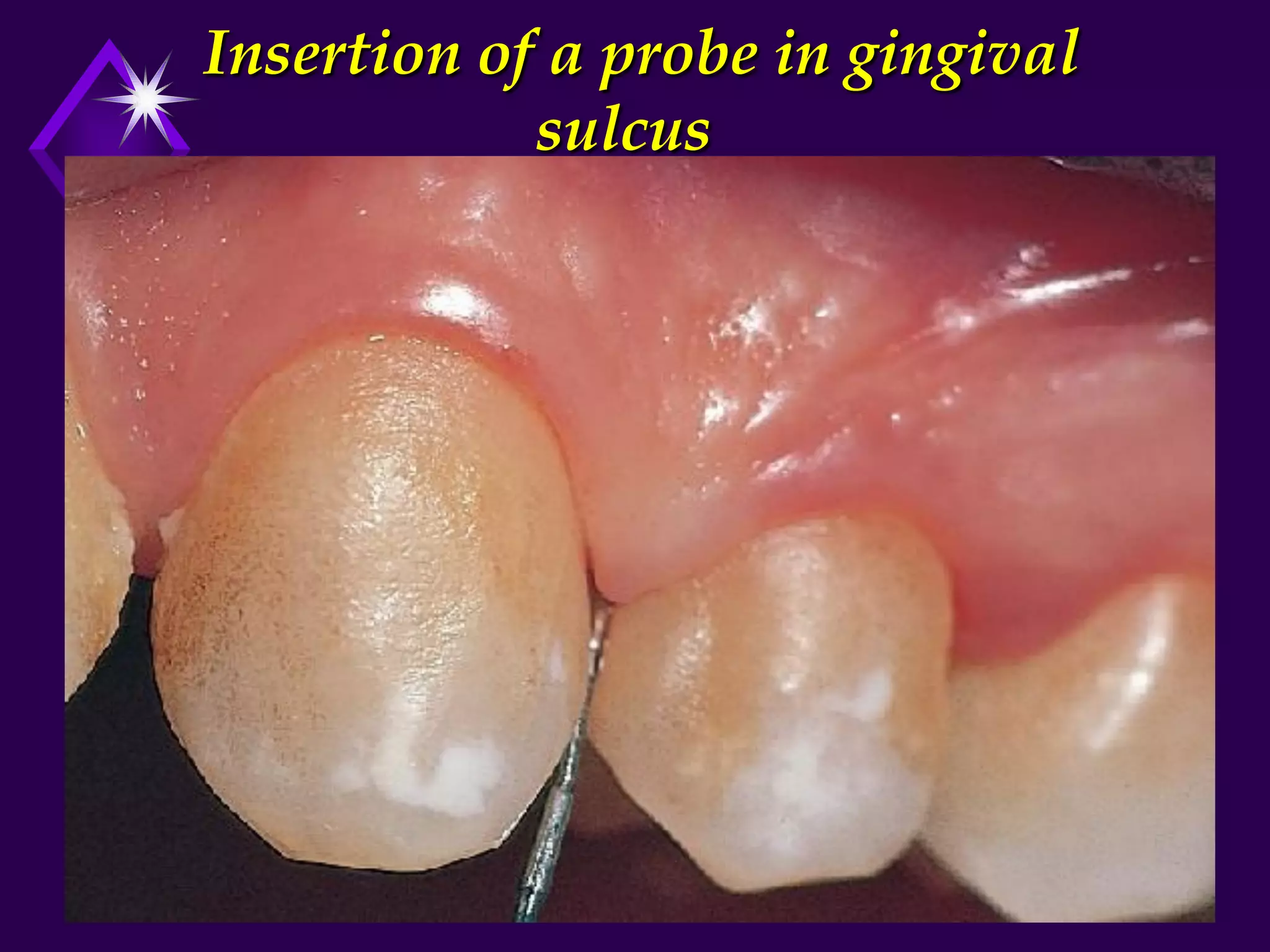 Chronic gingivitis | PDF