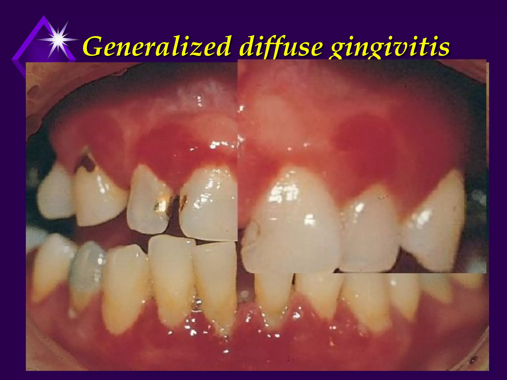 Chronic gingivitis | PDF