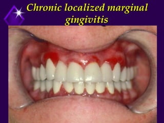 Chronic gingivitis | PDF
