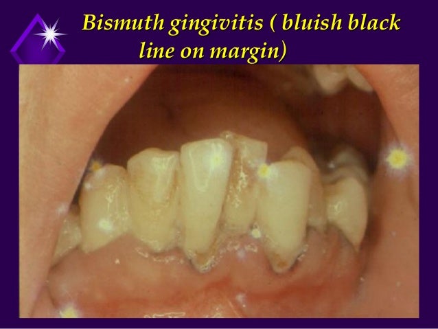 Chronic gingivitis