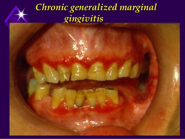 Chronic Gingivitis