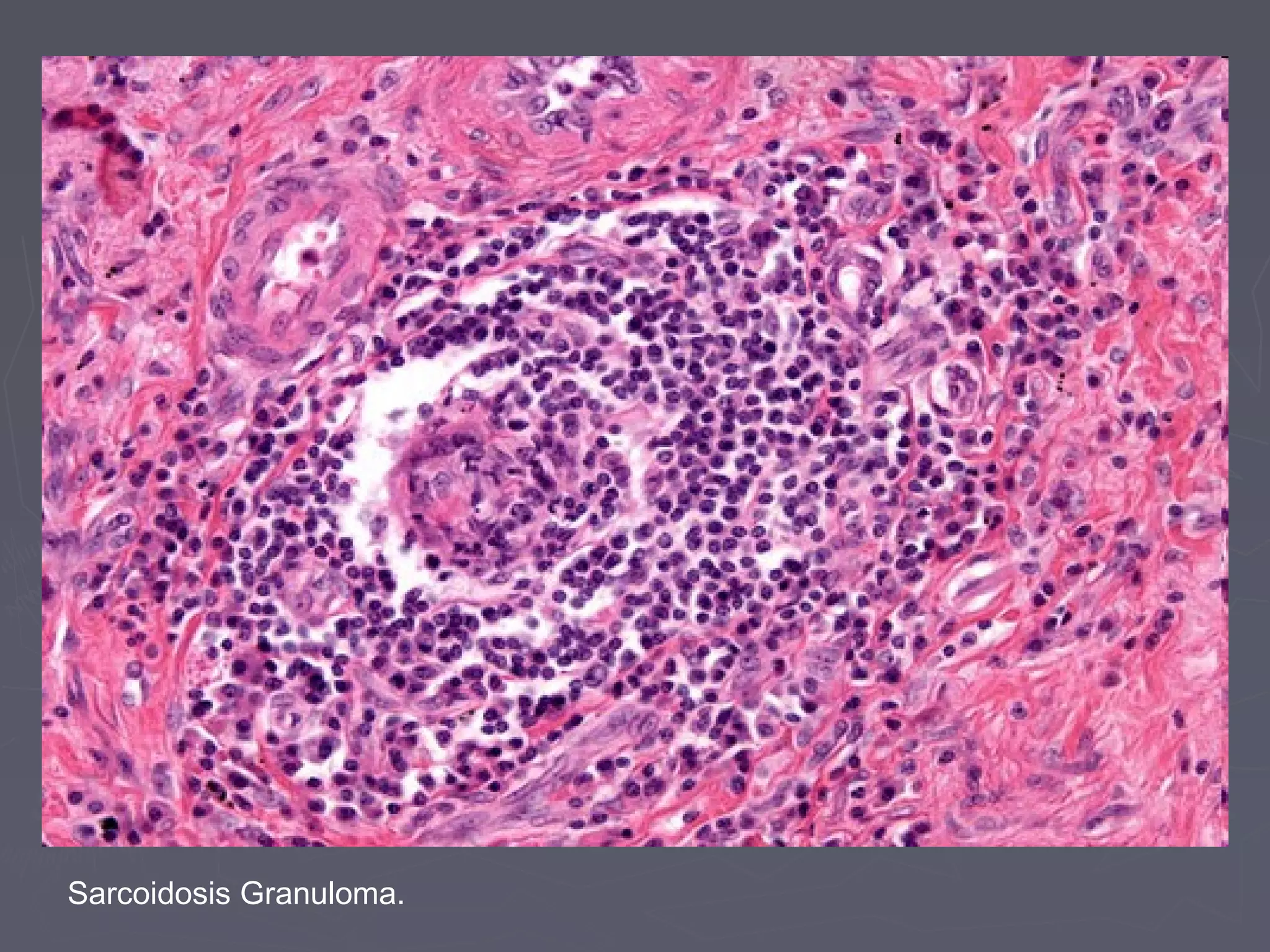 Chronic granulomatous inflammation | PPT