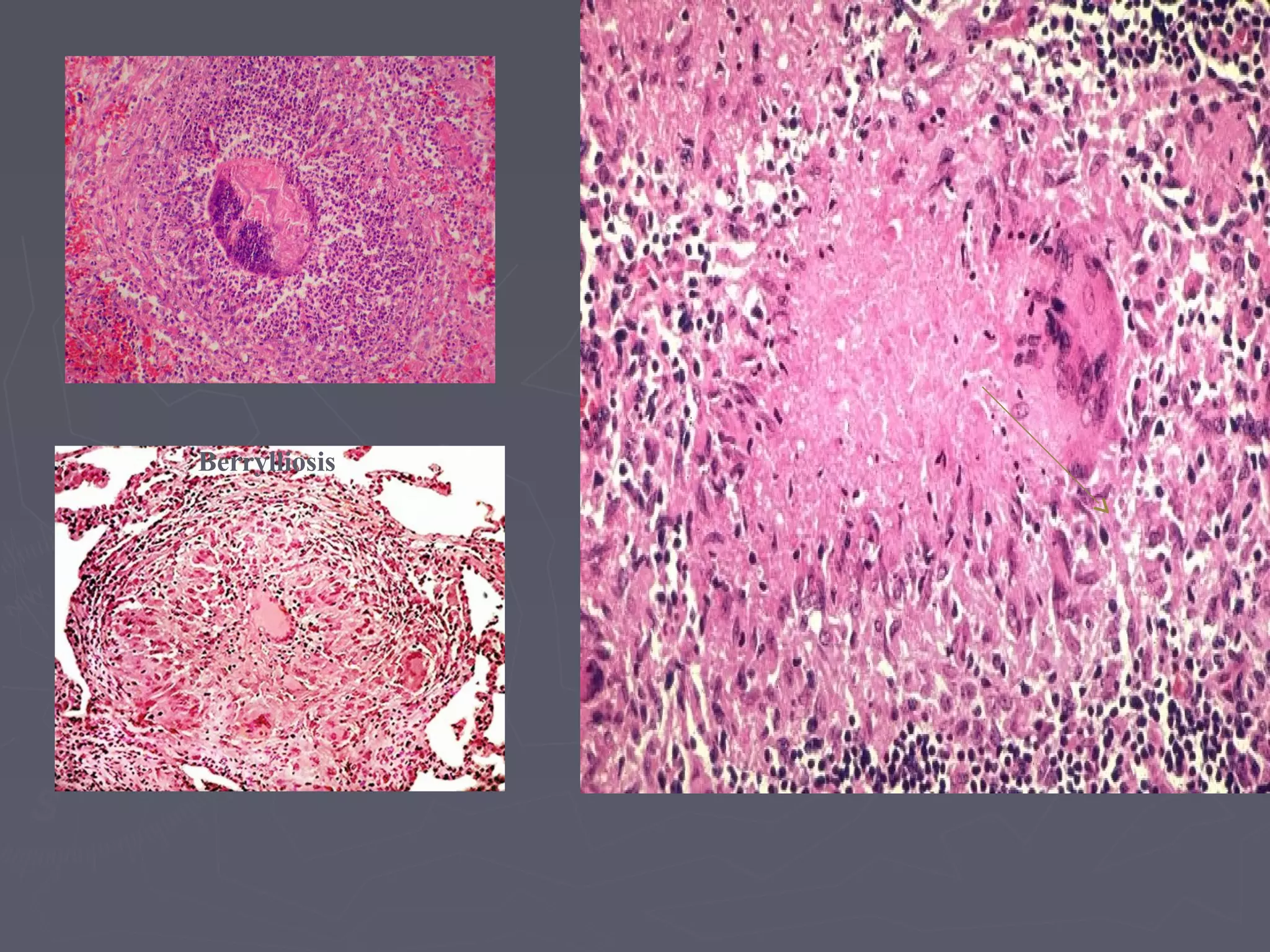 Chronic granulomatous inflammation