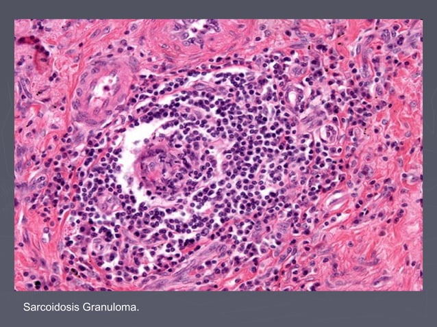 Chronic granulomatous inflammation | PPT | Infectious Diseases ...