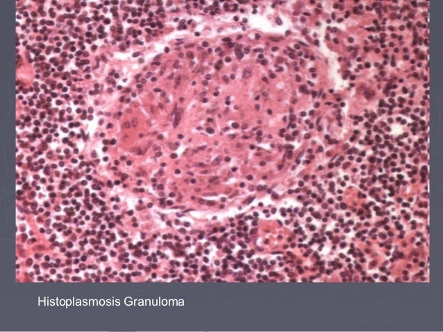 Chronic granulomatous inflammation