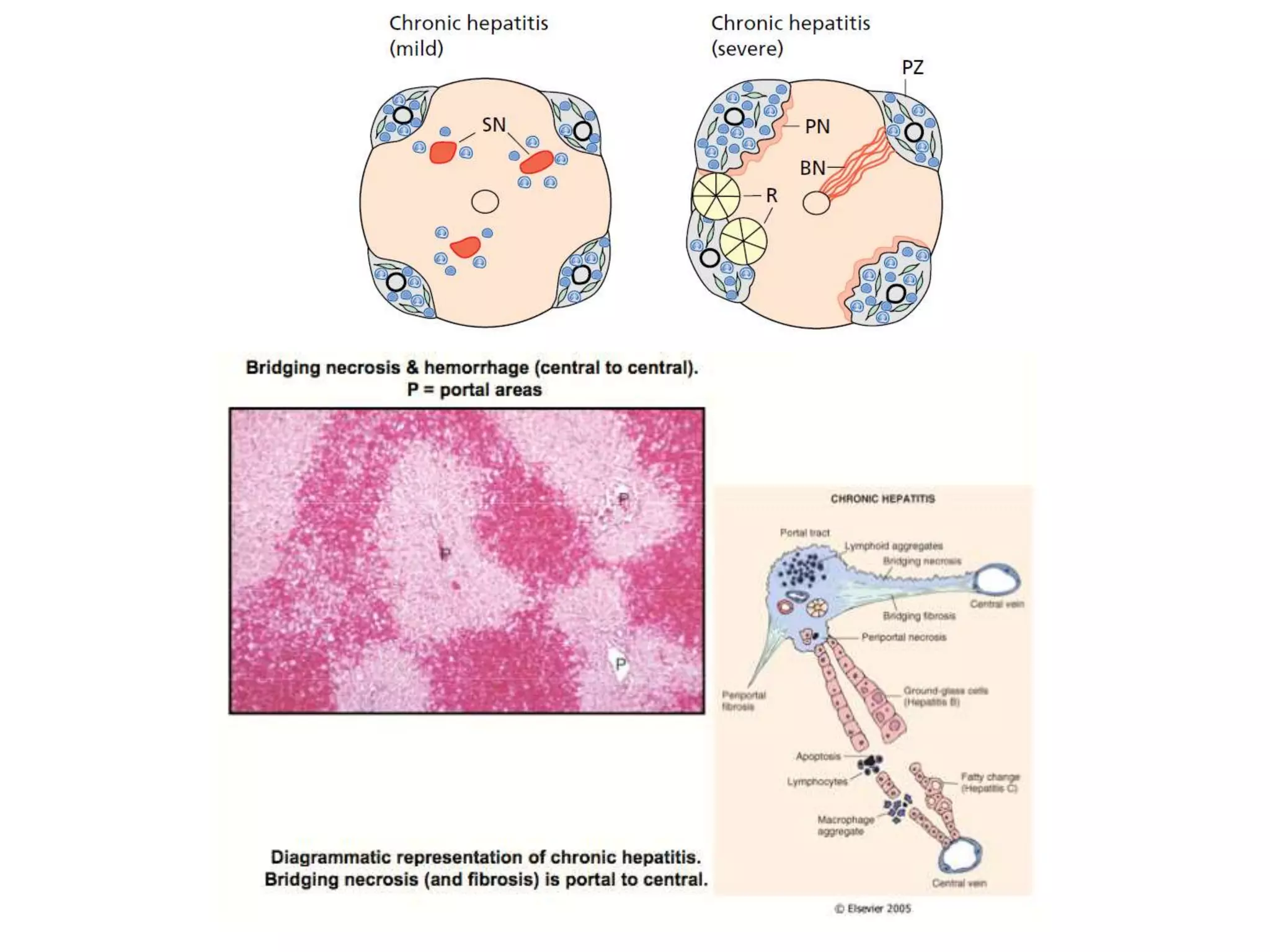 Chronic hepatitis | PPTX