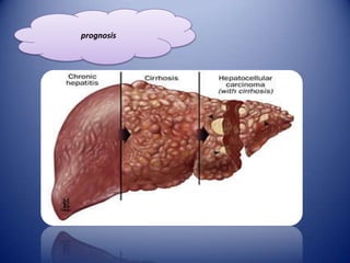 Chronic hepatitis introduction | PPTX