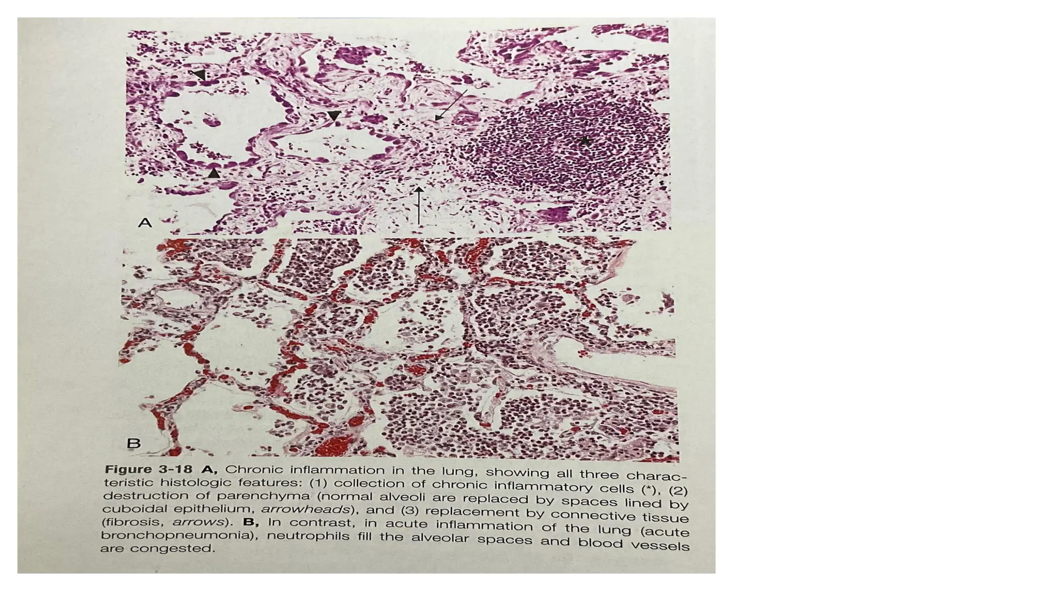 Chronic inflammation-1 mbbs ppt pathology.pdf
