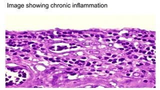 Chronic inflammation-1 mbbs ppt pathology.pdf
