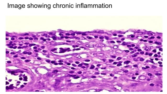 Chronic inflammation-1 mbbs ppt pathology.pdf | Biological Sciences ...
