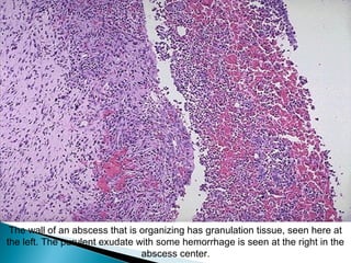 Chronic inflammation | PPT