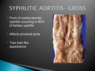 Tertiary Syphilis Aorta