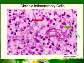 Chronic inflammation ppt | PPTX