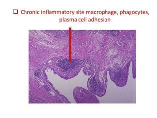 Chronic inflammation ppt | PPTX