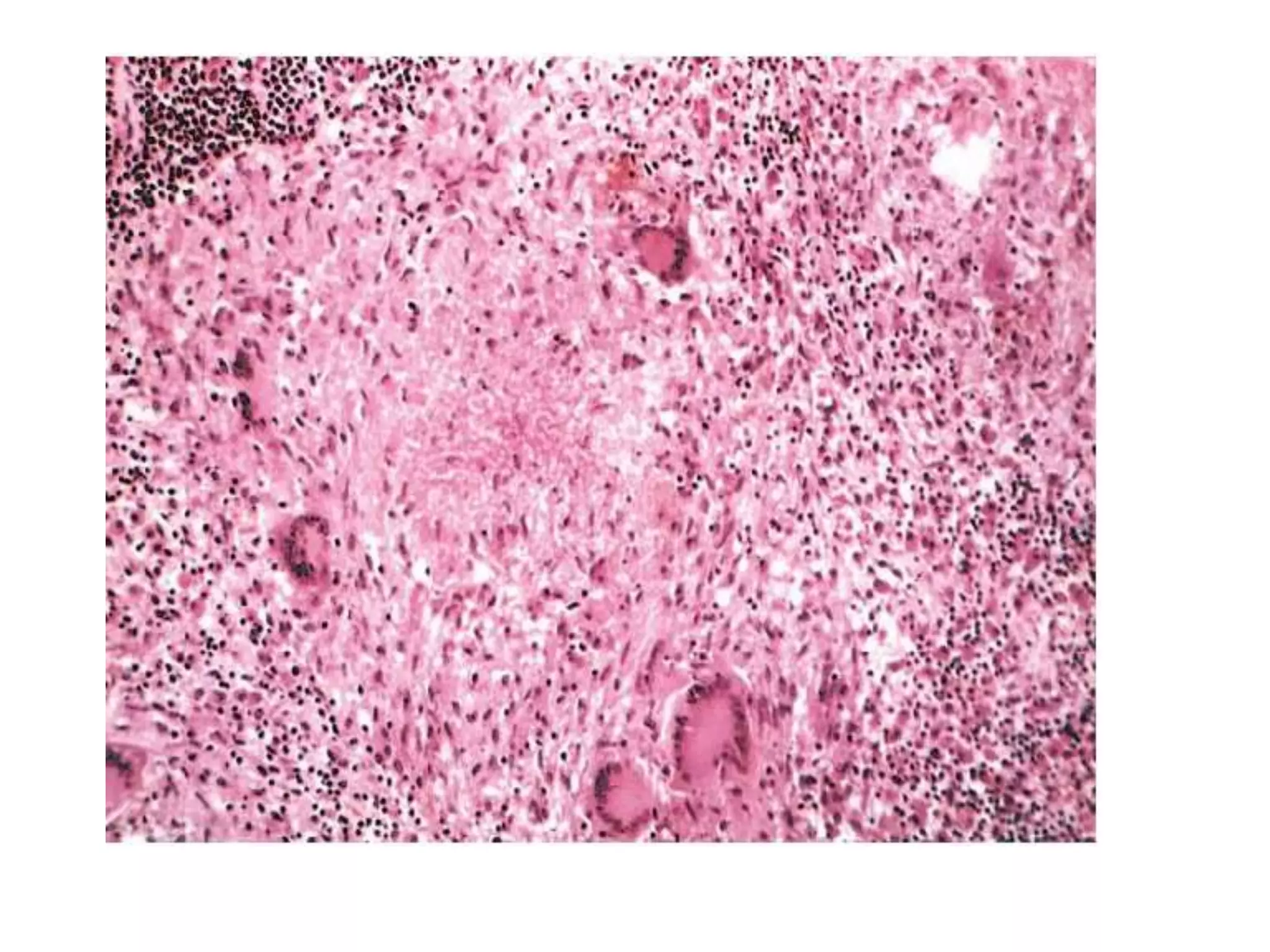 Chronic inflammation | PPT