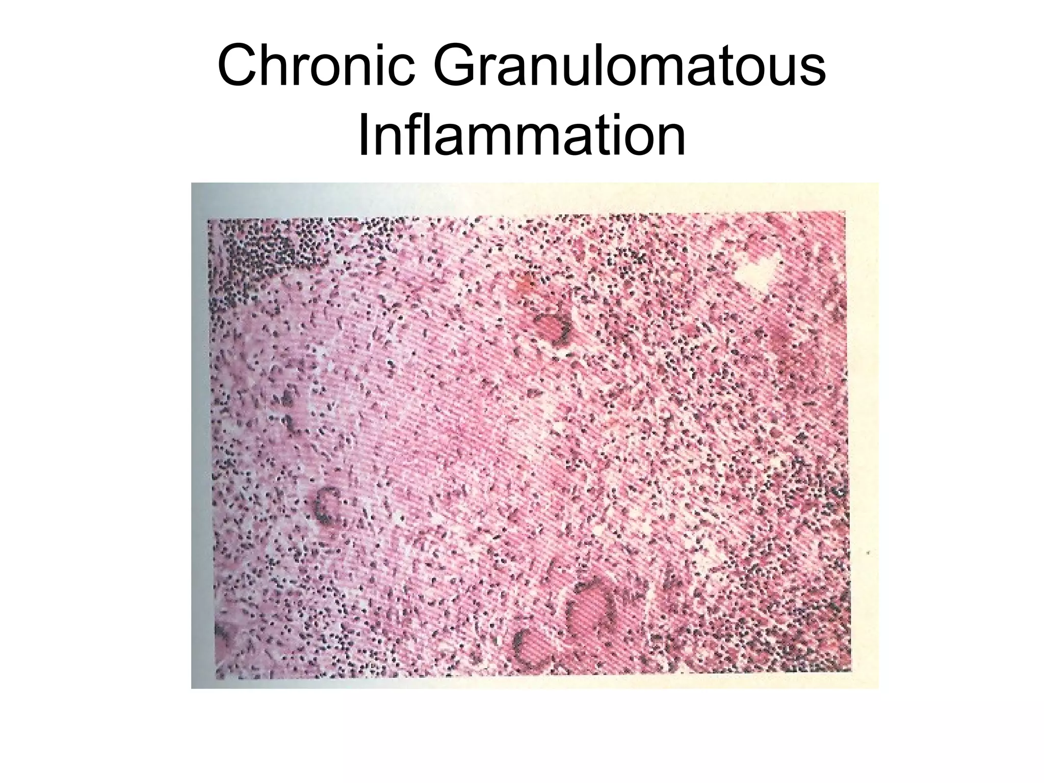 Chronic inflammation | PPT