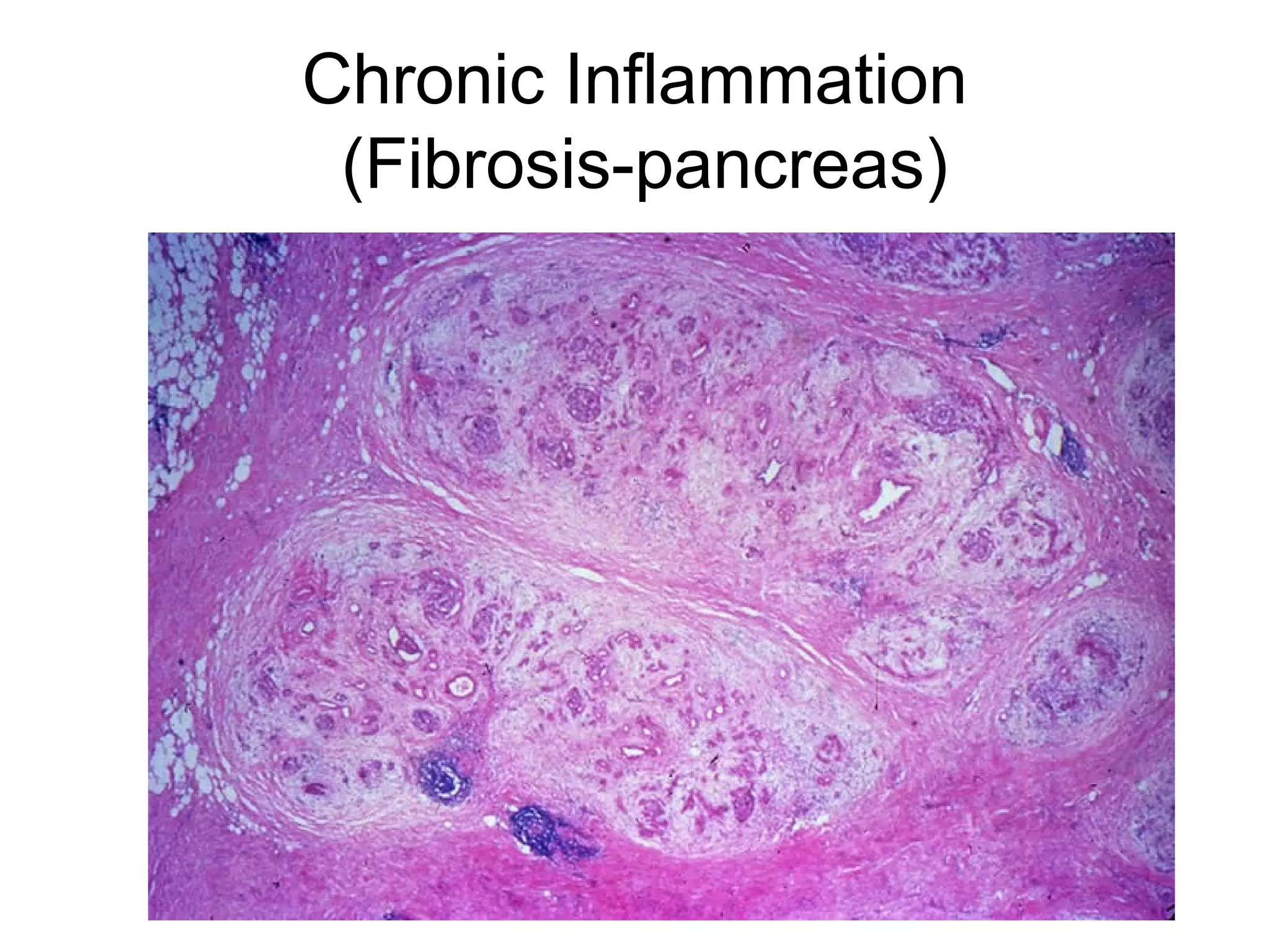 Chronic inflammation | PPT