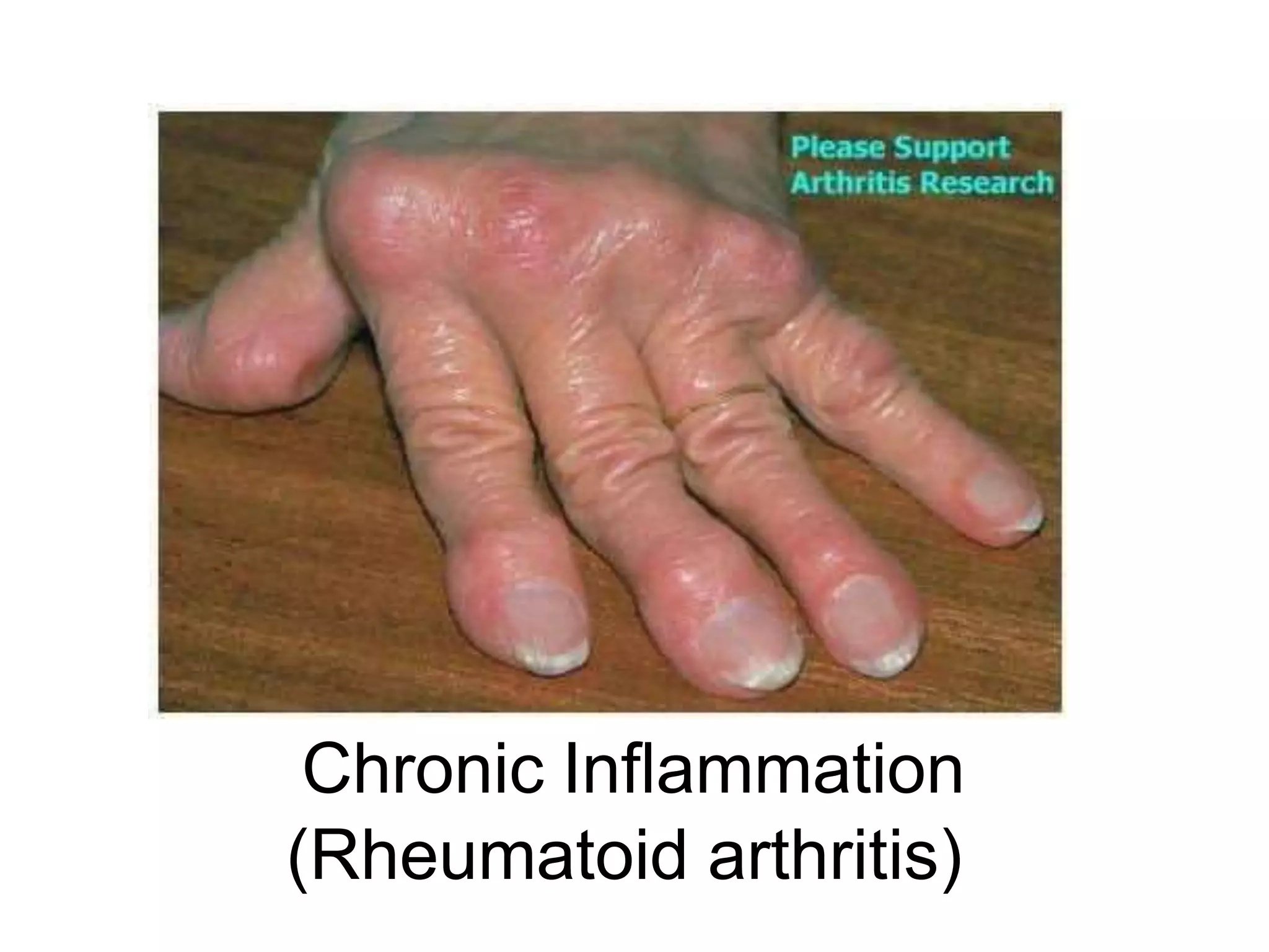 CHRONIC INFLAMMATION.pptx