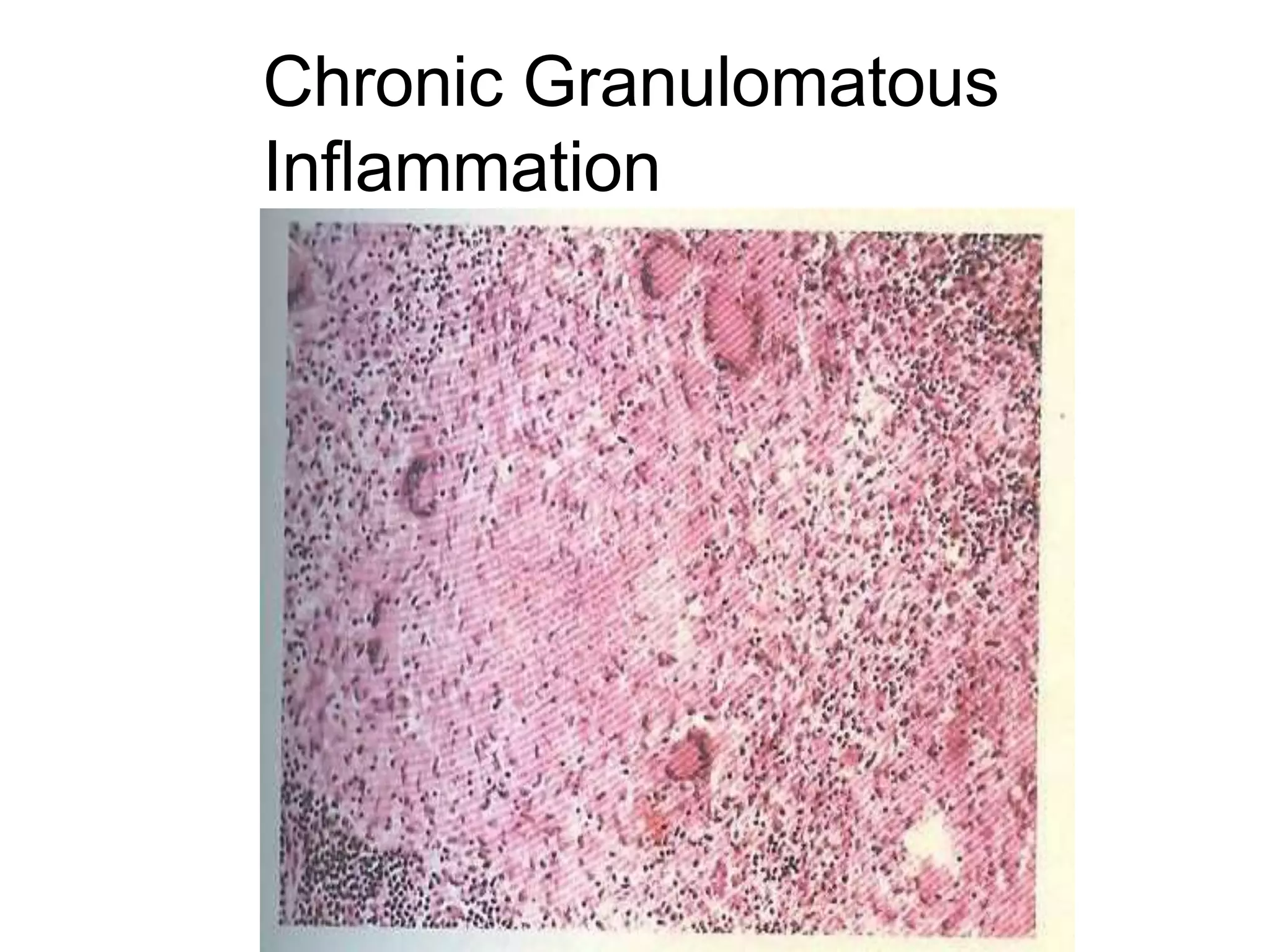 CHRONIC INFLAMMATION.pptx