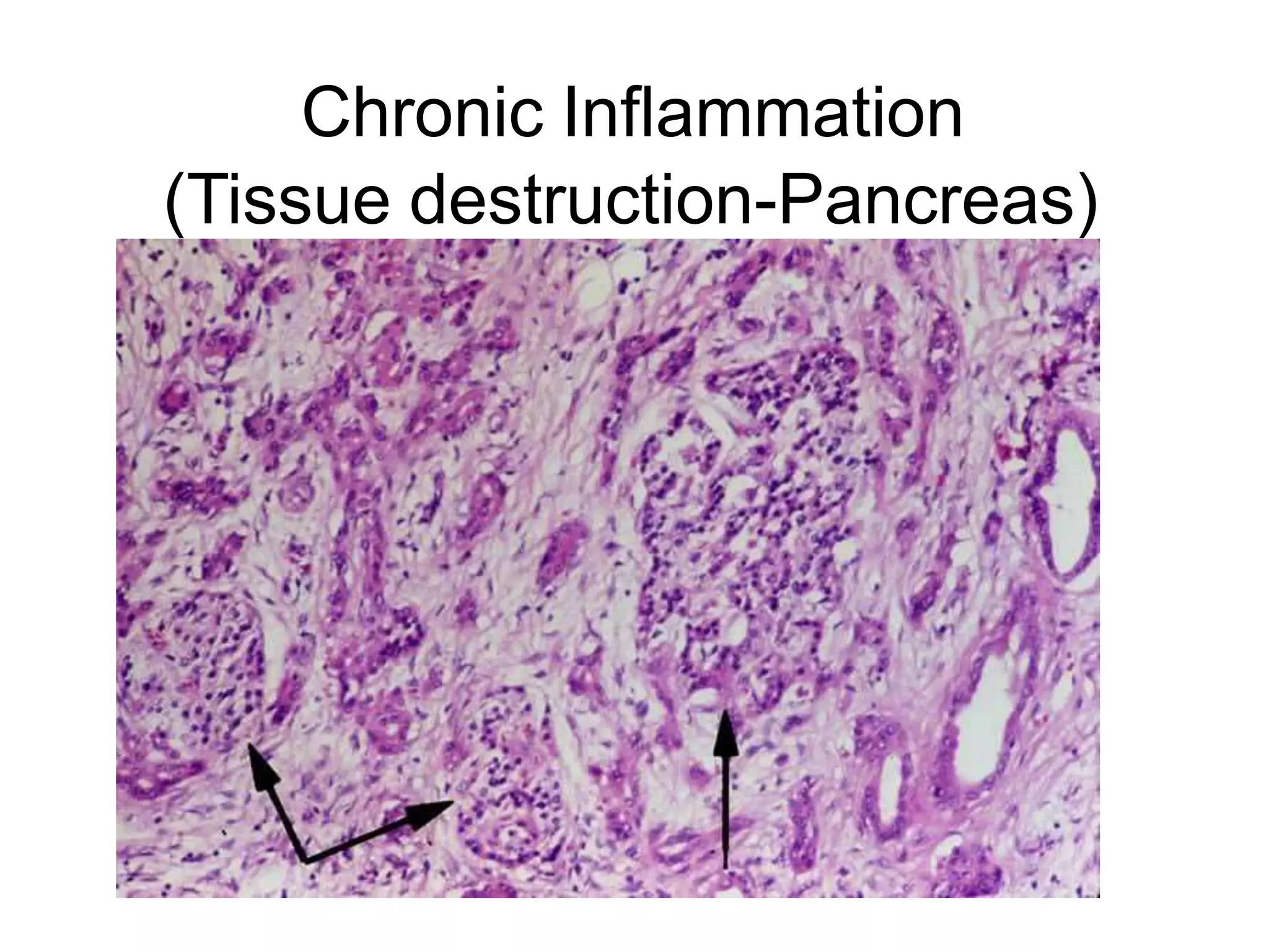 CHRONIC INFLAMMATION.pptx