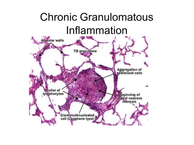 CHRONIC INFLAMMATION.pptx | Lung and Respiratory Health | Diseases and Conditions
