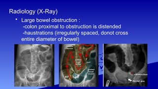 chronic intestinal obstruction in pakistan | PPTX