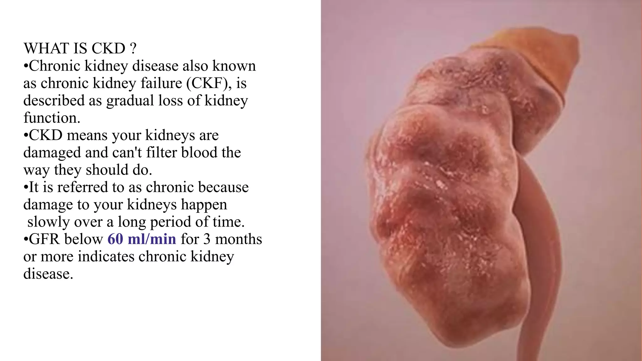 Chronic Kidney Disease (Case Study) | PPTX