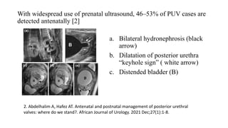 chronic kidney disease.pptx
