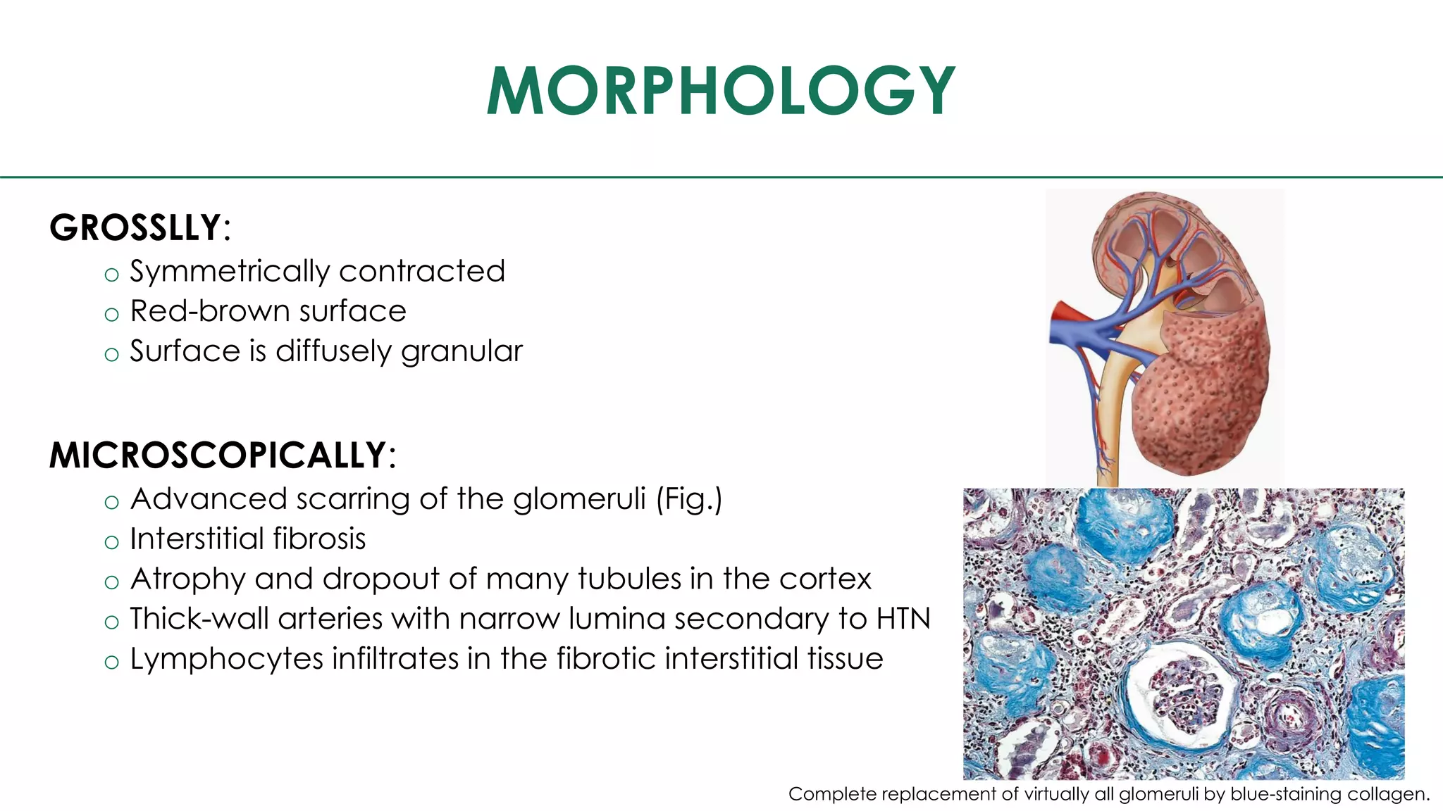 CHRONIC KIDNEY DISEASE & END STAGE RENAL FAILURE | PDF