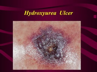 Chronic leg ulcer high critical topic for learning .ppt