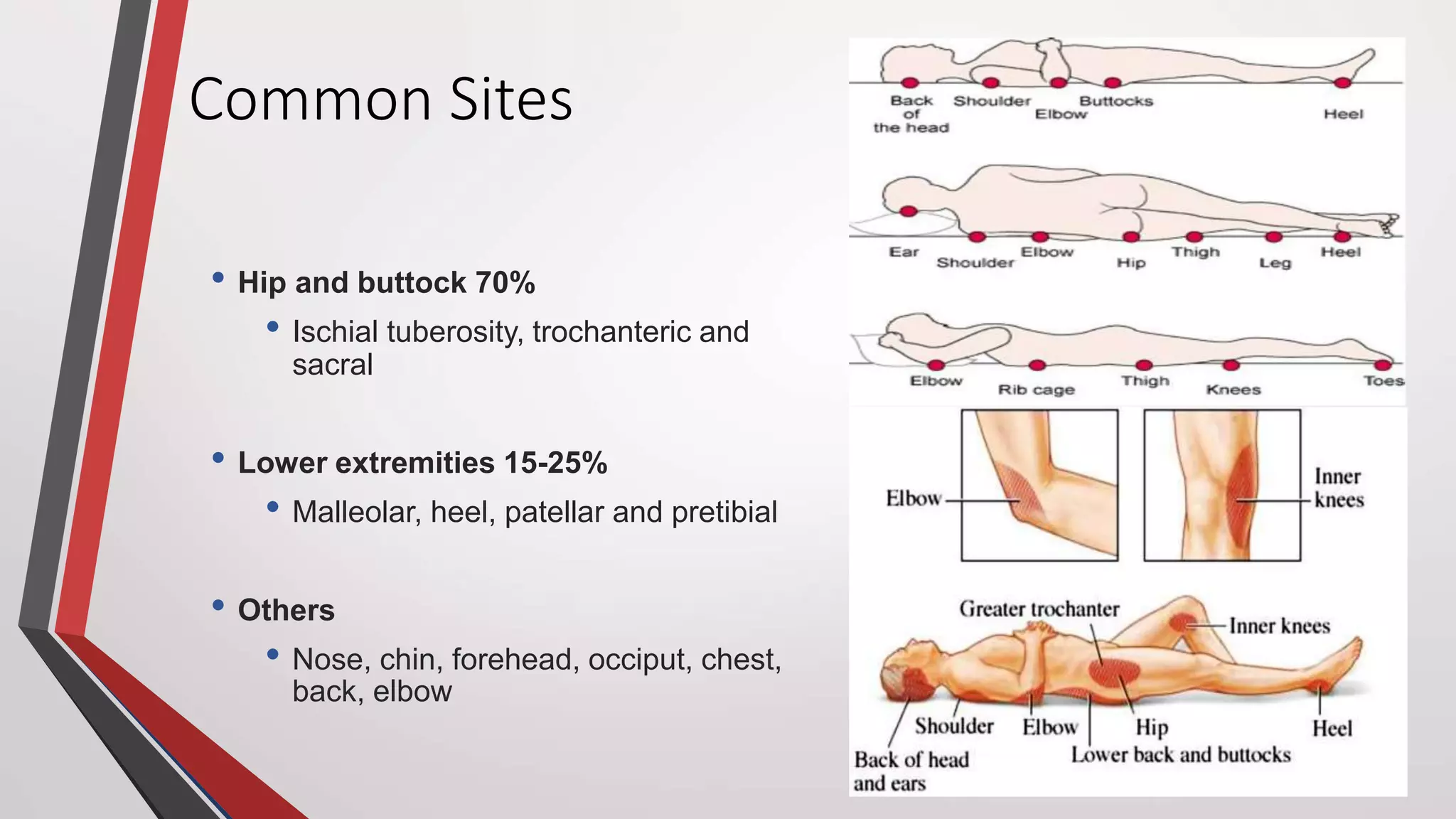 Chronic leg ulcers & pressure sore | PPTX