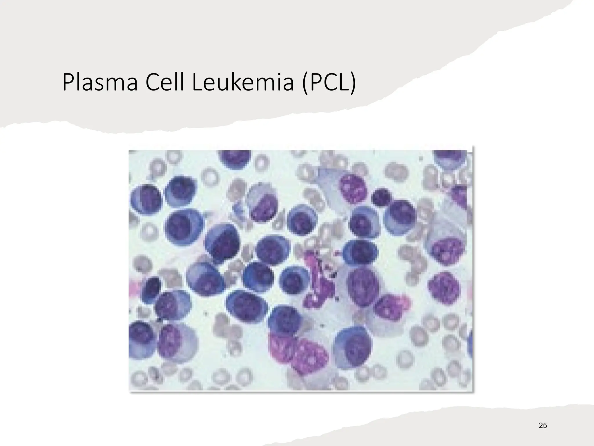 INTRODUCTION TO CHRONIC LEUKEMIA WHITE BLOOD CELLS MALIGNANCY | PDF