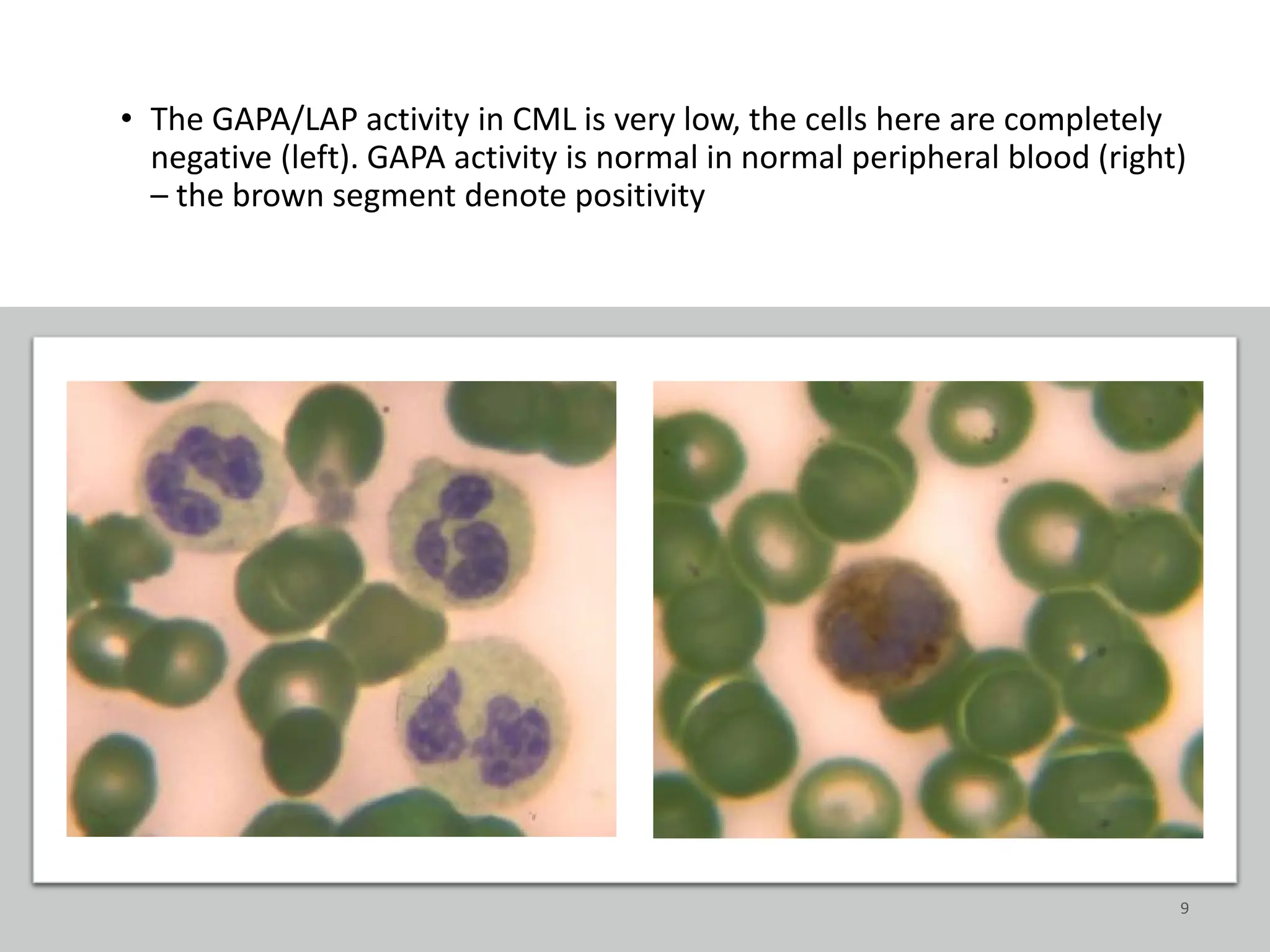 INTRODUCTION TO CHRONIC LEUKEMIA WHITE BLOOD CELLS MALIGNANCY | PDF