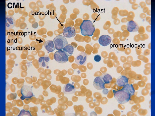 Chronic leukemias
