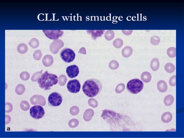 Chronic leukemias