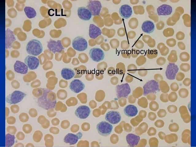 Chronic leukemias
