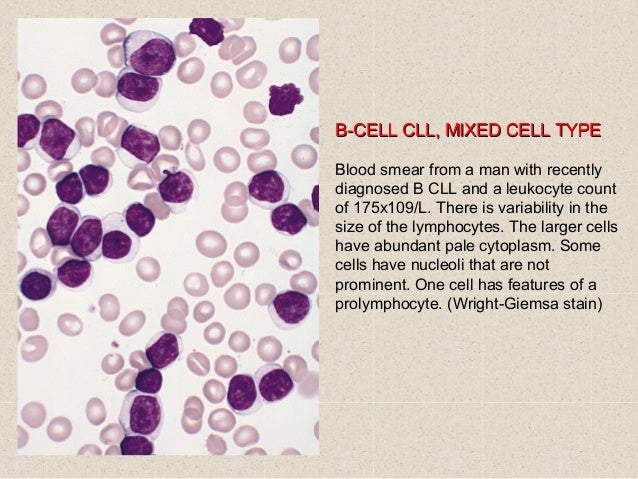 Chronic leukemias csbrp