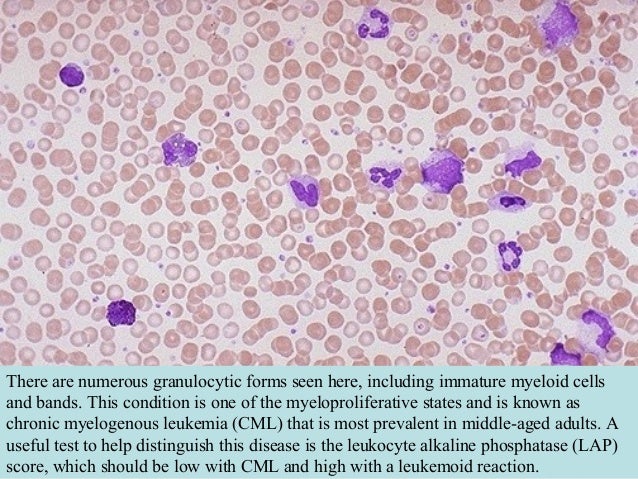 Chronic leukemias csbrp