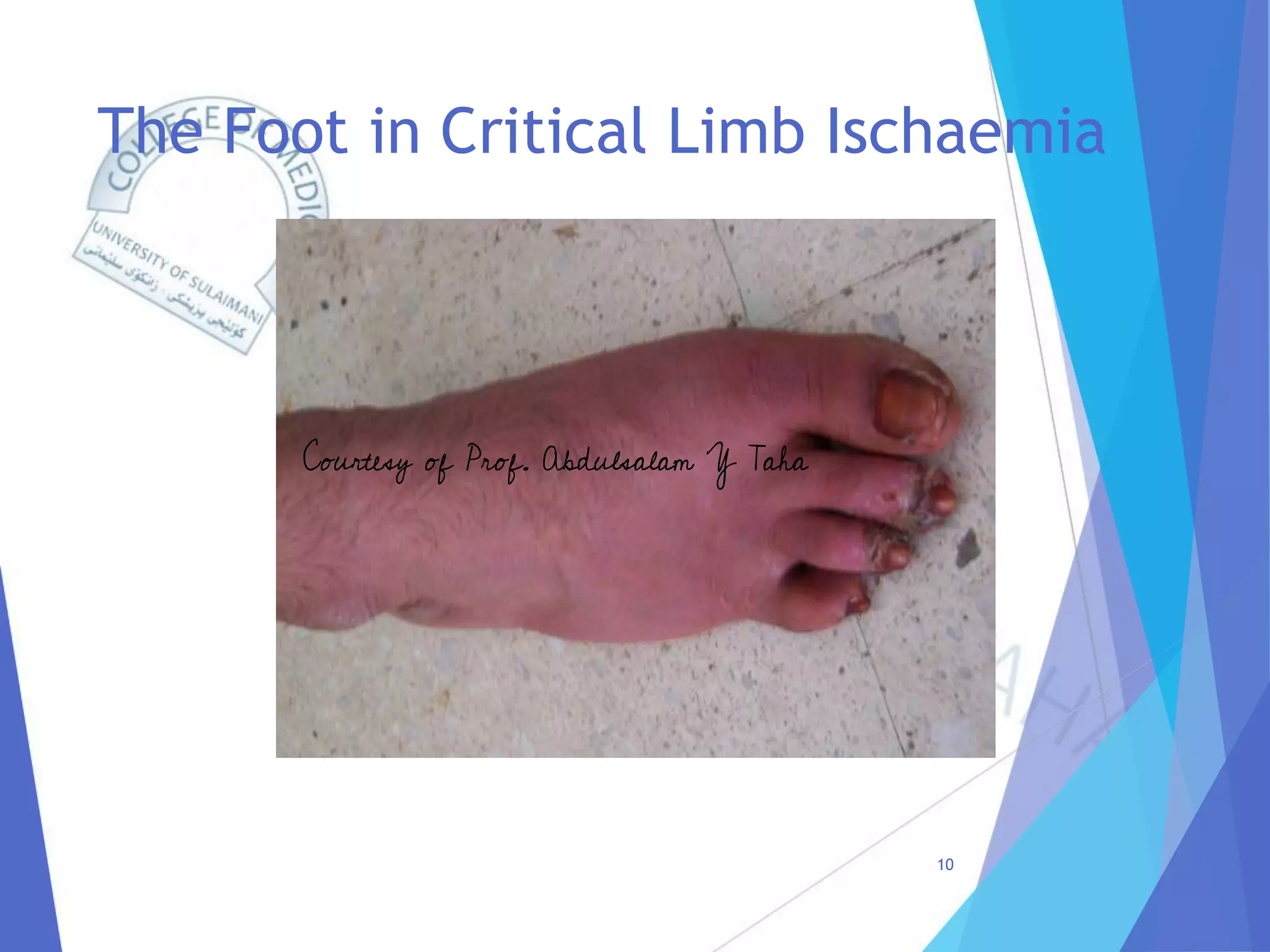 Chronic Limb Ischaemia.pdf