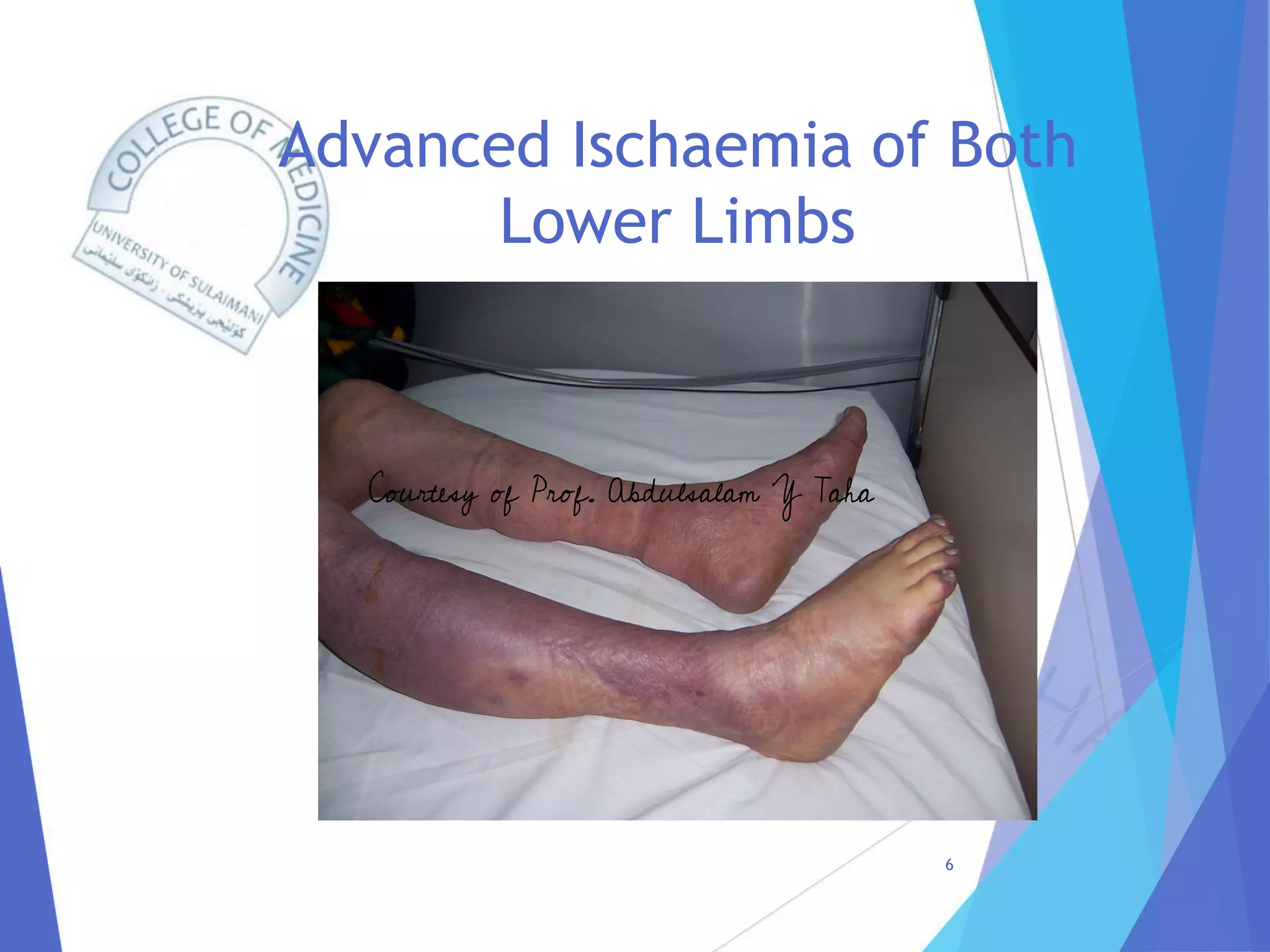 Chronic Limb Ischaemia.pdf