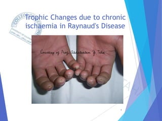 Chronic Limb Ischaemia.pdf