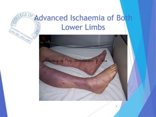 Chronic Limb Ischaemia.pdf