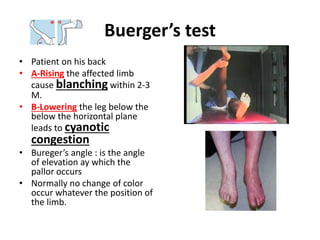 Chronic limb ischemia by Muhamad Fathy (MD) | PPT