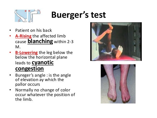 Chronic limb ischemia by Muhamad Fathy (MD)
