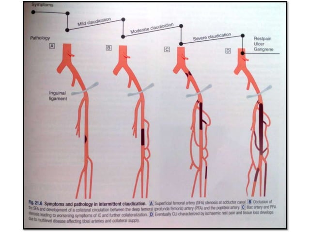 Chronic limb ischemia | PPTX | Diseases and Conditions | Medical Health