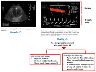 Chronic limb ischemia | PPTX