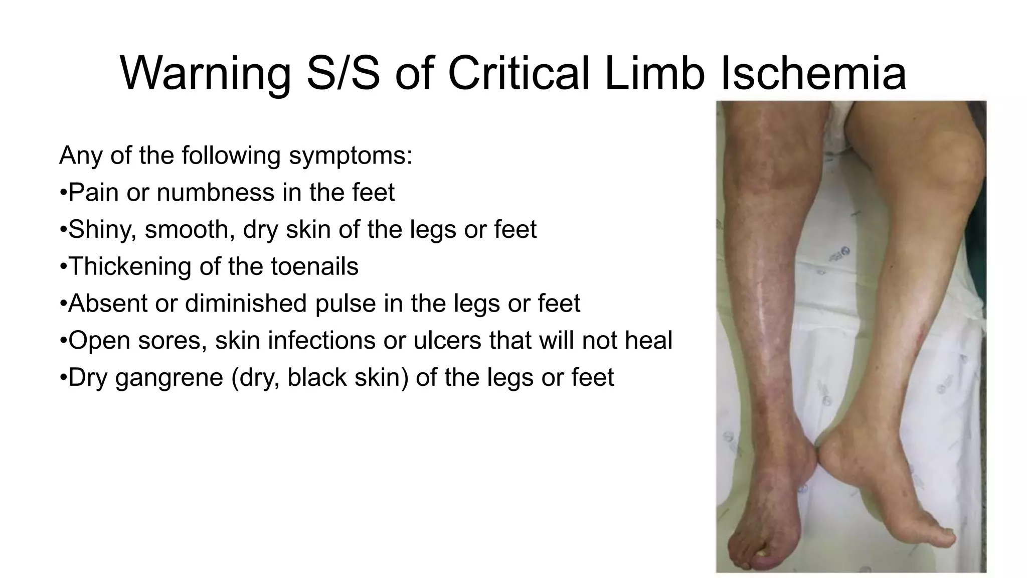 Peripheral Vascular disease / Chronic limb ischemia / CLI / Acute limb ...