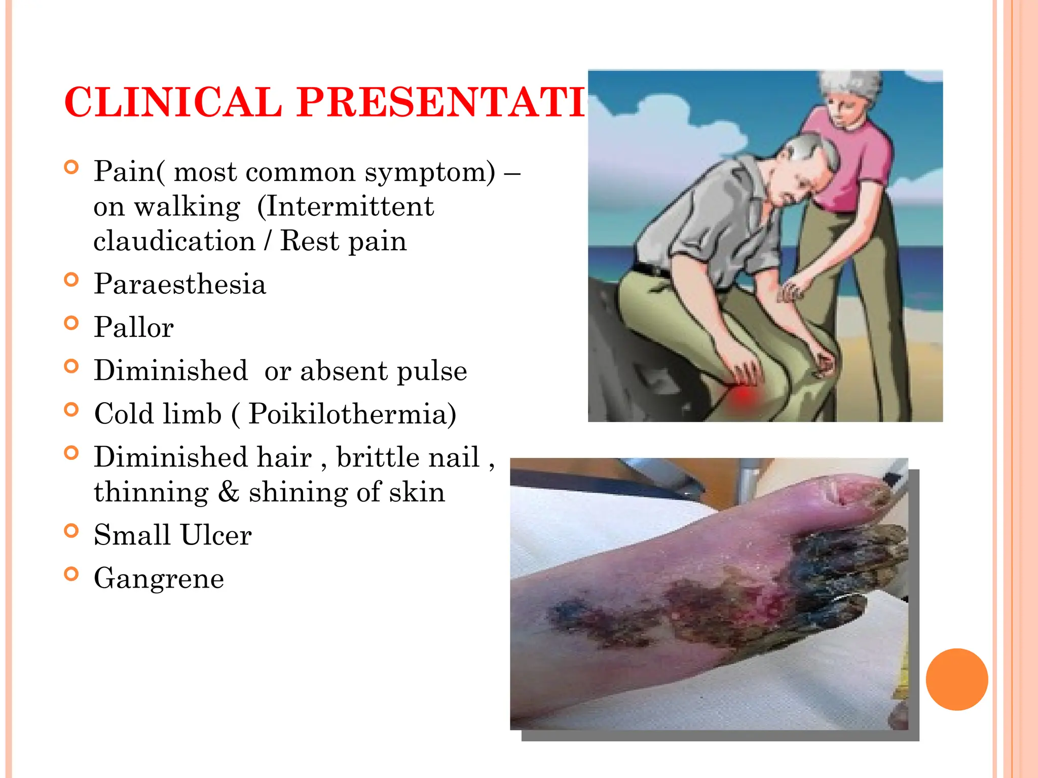 chroniclimbischemianew-copy-160423180154.ppt